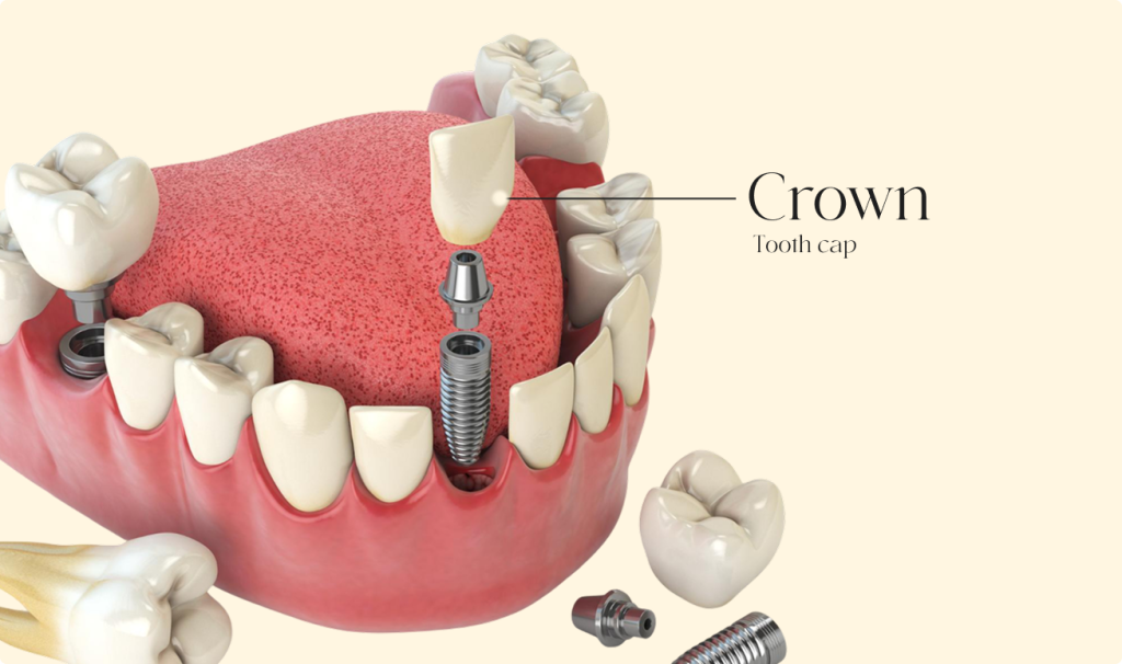 The True Cost of Dental Implants Without Insurance: No Surprises