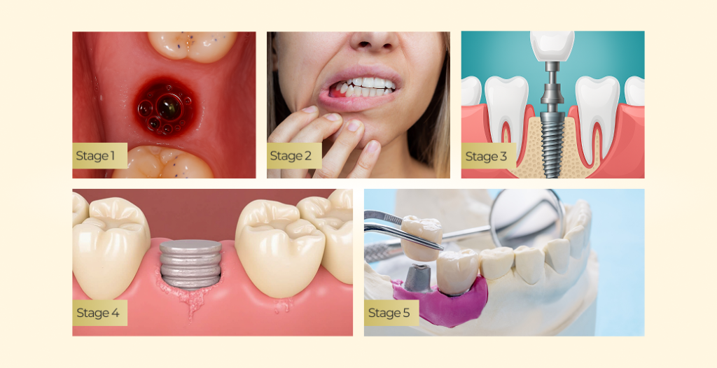 Dental Implant Healing Stages: What to Expect After Surgery