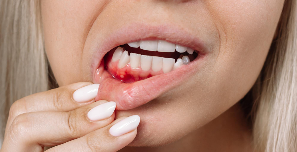 Signs of Root Canal Infection that You Should Not Avoid