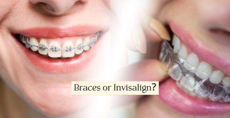 Braces vs Invisalign: Which Is Better for You | Crystal Clear Dental